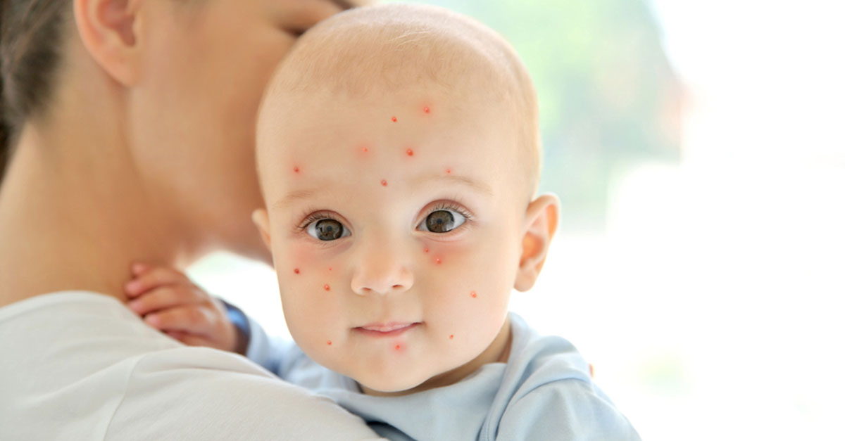 Windpocken bei Säuglingen